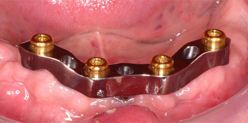 Milled Bar overdenture - Williams Lake Smiles