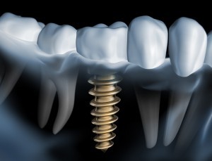 Osseointegration: The Science Behind Dental Implants